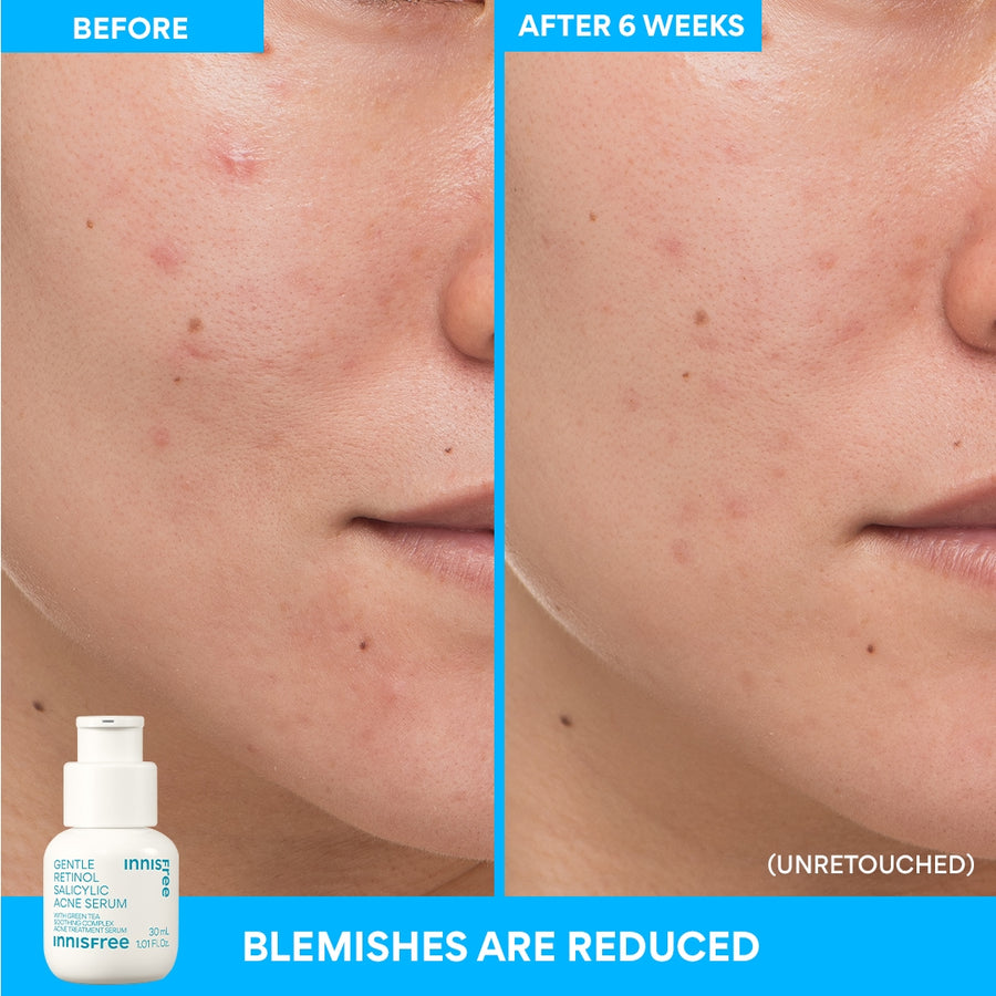 Retinol Acne Treatment for Face | Gentle Retinol Salicylic Acne Serum ...